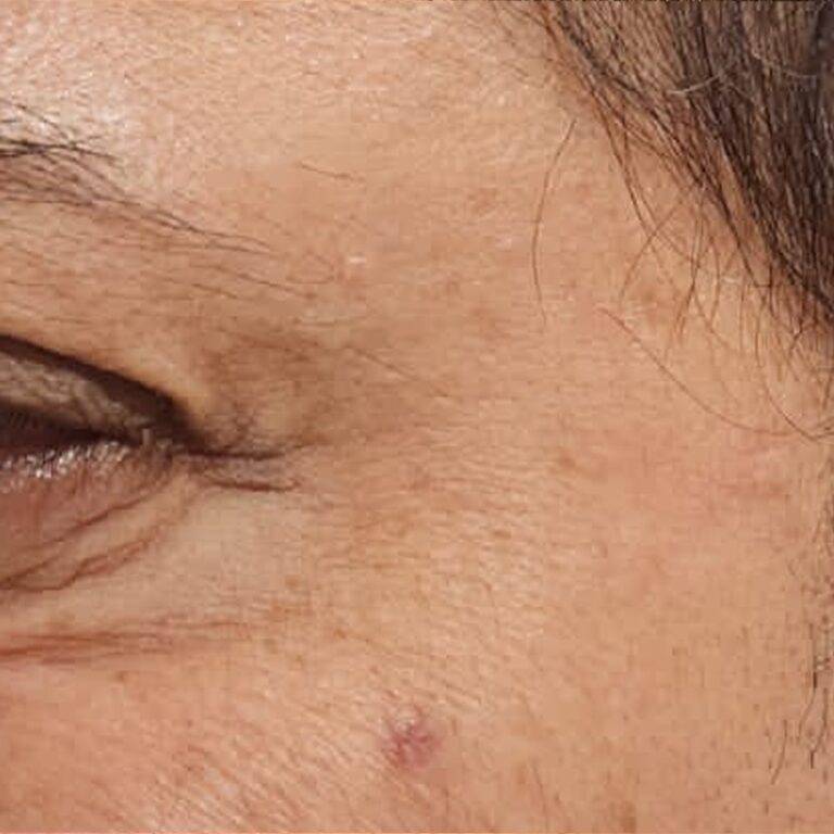 Aesthetics Lab: HydraFacial, Laser, Carbon Peel & More