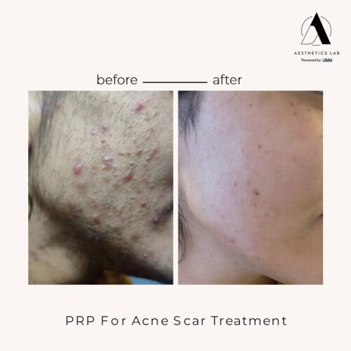 aesthetics lab : PRP for Acne Scars with 4-Effective Treatment for ...